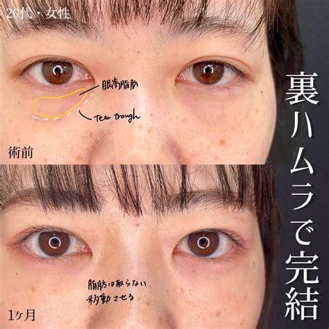 裏ハムラで完結 」に関する美容整形の症例写真の詳細 新宿・池袋・大宮で人気の美容整形は東京シンデレラ美容外科