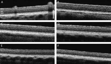 Representative Optical Coherence Tomography Oct Scans Of The Right Download Scientific