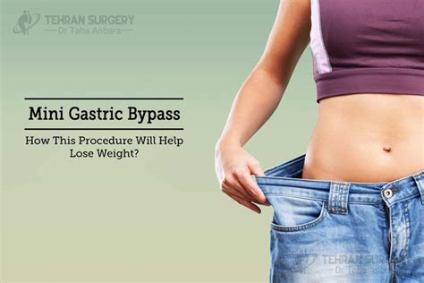 Mini Bypass Mini Gastric Bypass Dr Taha Anbara