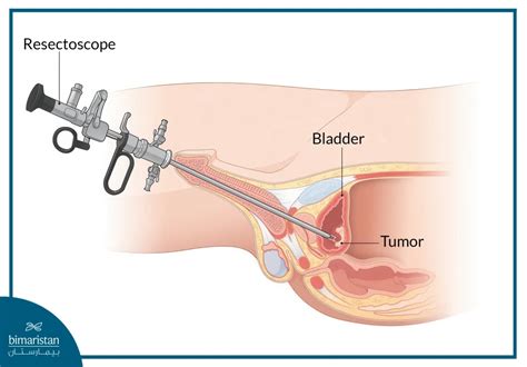 Bladder Cancer Surgery When Its Done And What Risks Involve