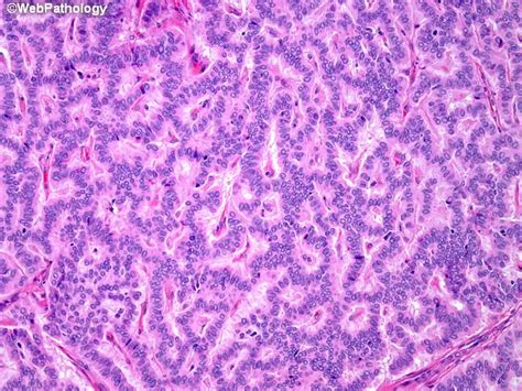 Well Differentiated Neuroendocrine Tumor