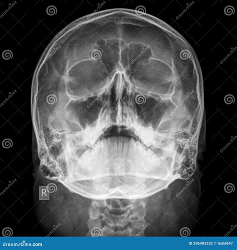 Sinus X Ray Image PA View Stock Photo Image Of Radiograph 296483332