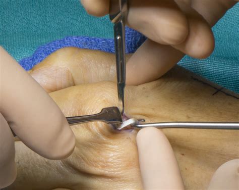 Technique Eip To Epl Tendon Transfer Luanmd