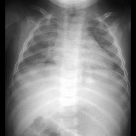 Pediatric Rib Fracture Pediatric Radiology Reference Article