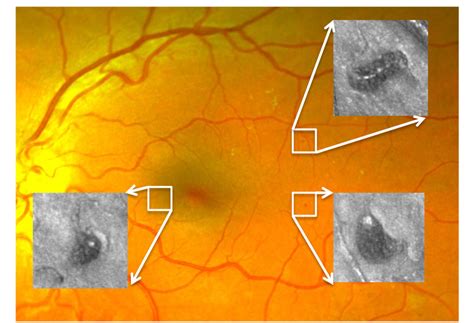 Figure 1 From Estimation Of Diabetic Retinal Microaneurysm Perfusion