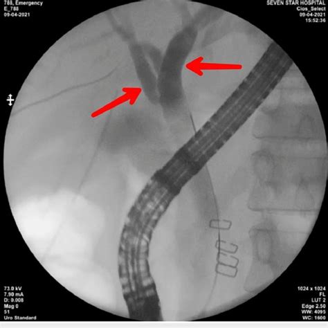 Ercp In Lbs Shows The Cbd And Chd Completely Filled With Thick Limy
