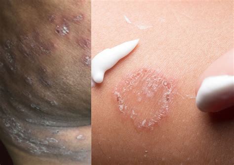 Never Before Seen Strain Of Ringworm Discovered In Kzn