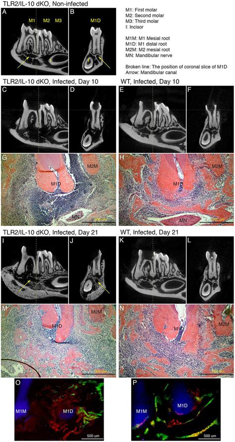 Histopathology Of Periapical Lesions In Tlr2il 10 Dko And Wt Mice A