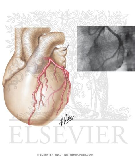 Left Coronary Artery Left Anterior Oblique View