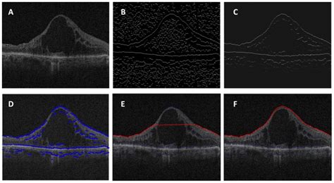 A A Representative OCT B Scan B Detection Of Image Contrast Change Download Scientific