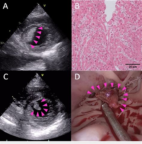 Left Ventricular Thrombus A Left Ventricular Thrombus In Apex Download Scientific Diagram