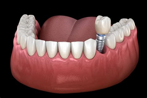 Choosing A Periodontist For Lasting Dental Implants