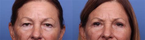 Blepharoplasty Before And After Pictures Case 433 Scottsdale Az