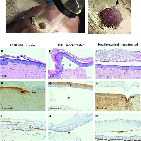 Skin Fragility Suction Test A And B Blistering Black Arrow Induced