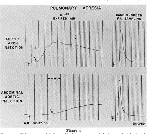 Injection Intracardiaque