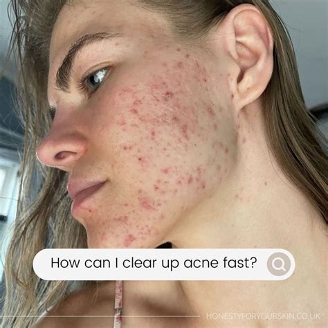 Acne Wont Go Away Help These Are The 5 Hidden Reasons Why Bad