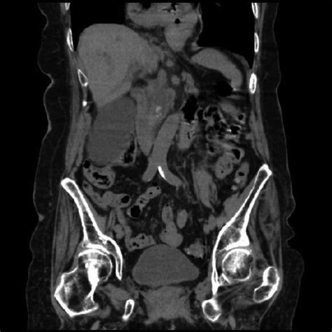 Pdf The Rendezvous Technique Involving Insertion Of A Guidewire In A Percutaneous Transhepatic