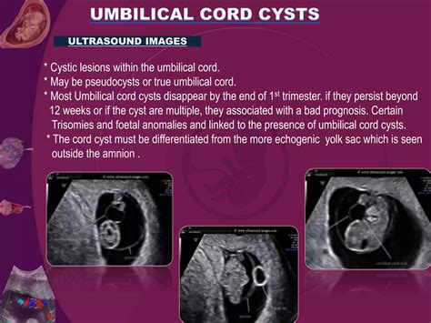 Umblical Cord Presentation Pptx
