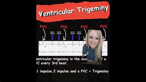 Ventricular Trigeminy Ems Cardiology Youtube