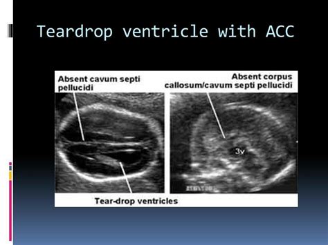 Bicornuate Uterus Ultrasound
