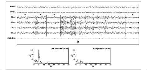 cyclic alternating pattern a1 subtypes during s1 characterized by