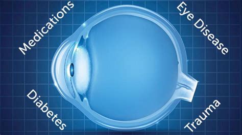 Causas Del Glaucoma Secundario