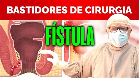 Cirurgia De FÍstula Perianal Bastidores Com Dr Paulo Branco