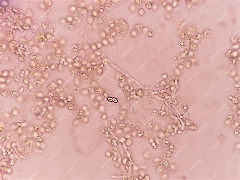 Vaginal Candidiasis Microscopy