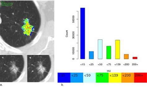 Figure From Pulmonary Nodule Characterization A Comparison Of Conventional With Quantitative