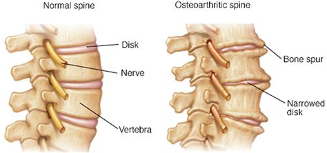 Osteoarthritis Causes Symptoms Diagnosis Prognosis And Treatment