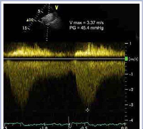 Doppler Recording From The Suprasternal View Illustrating Significant