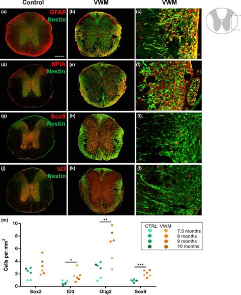 Fig Ure 2 Glial Abnormality And Cell Density In The White Matter Of The
