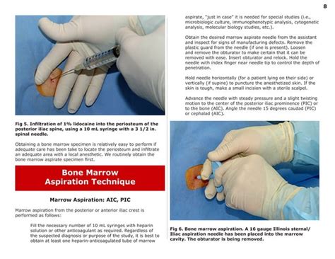 Bone Marrow Aspiration Technique Pdf