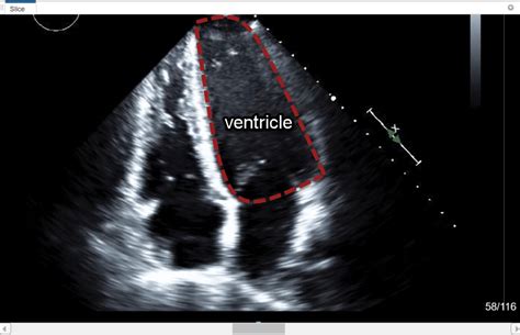 Label 2 D Ultrasound Series Using Medical Image Labeler Matlab And Simulink