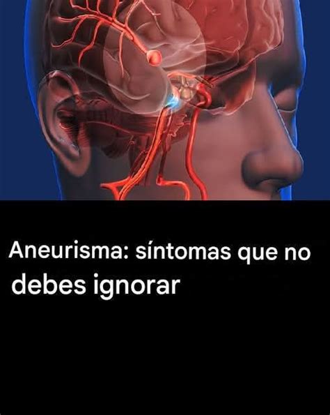 ¿qué Es Un Aneurisma Causas Síntomas Y Cuándo Buscar Ayuda Corte De