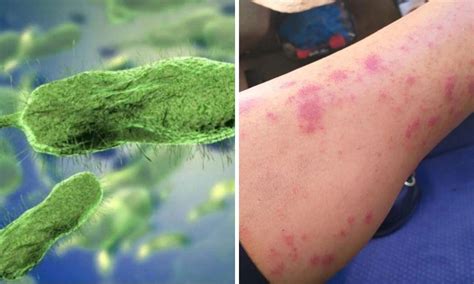 Nueva Bacteria En Playas De México “devoradora De Carne” El Mundo