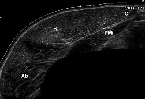 Mri Anatomy Pectoralis Major Muscle At Shirl Ketner Blog