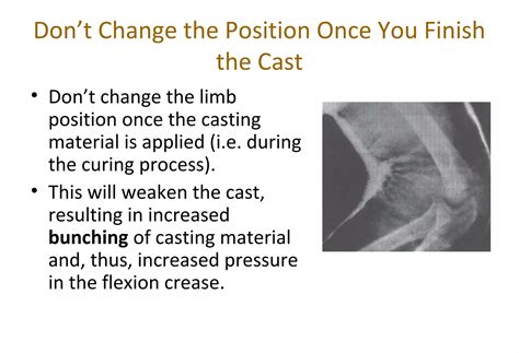 Casting And Splinting Principles And Common Pitfalls Ppt