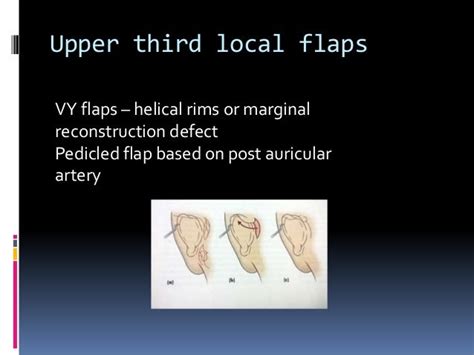 Defect Based Reconstruction Of Ear
