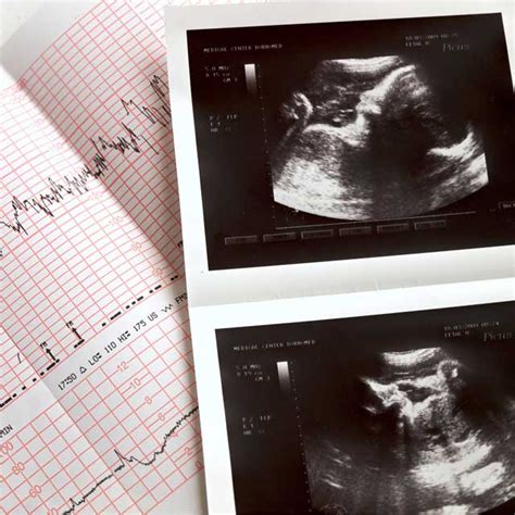 Congenital Heart Disease And Pregnancy Planning Risks And Safety
