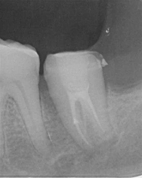 Case 2 Another Crack Tooth With C Shape Canal Perawatan Saluran Akar