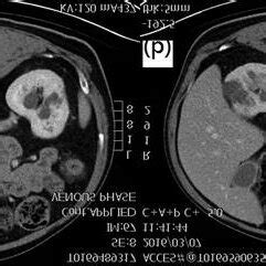 Abdominal Computed Tomography Scans Before And After Concurrent