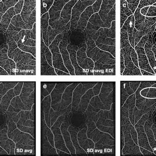 Superficial Capillary Plexus OCTA Images Of A Healthy Subject Averaged Download Scientific