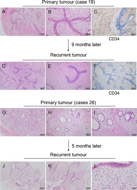 Phyllodes Tumours With Fa Like Feature A Predominantly Download