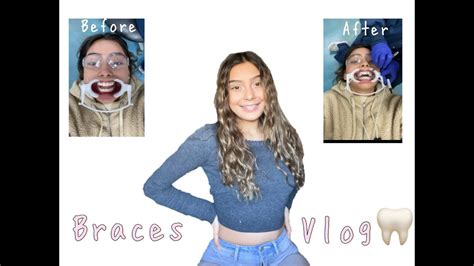 Braces Vlog Youtube