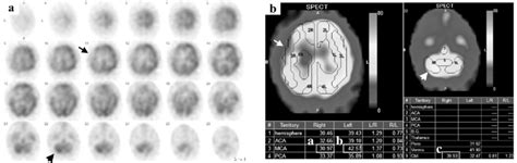 Single Photon Emission Computerized Tomography Of The Same Patient In Download Scientific