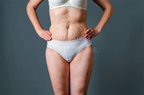 Front View Of The Skin Of A Woman With Stretch Marks And Flabby Skin