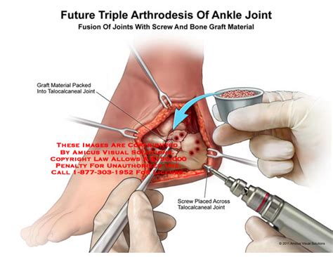 AMICUS Illustration Of Amicus Surgery Ankle Joints Future Triple