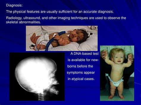 Ppt Achondroplasia Powerpoint Presentation Free Download Id1307684