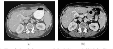 Figure 1 From Intrahepatic Sarcomatoid Cholangiocarcinoma Semantic